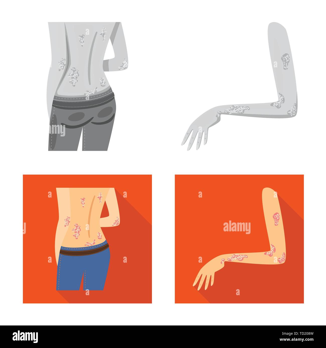 psoriasis,skin,dermatitis,body,eczema,rash,allergy,itch,stress,sick ...