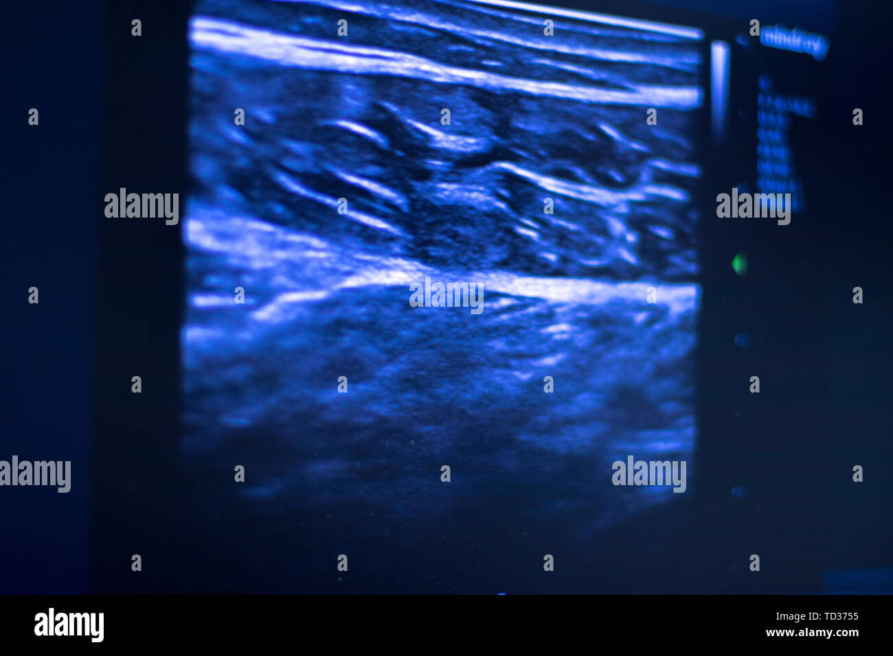 EPI Intratissue Percutaneous Electrolysis dry needling ultrasound ...