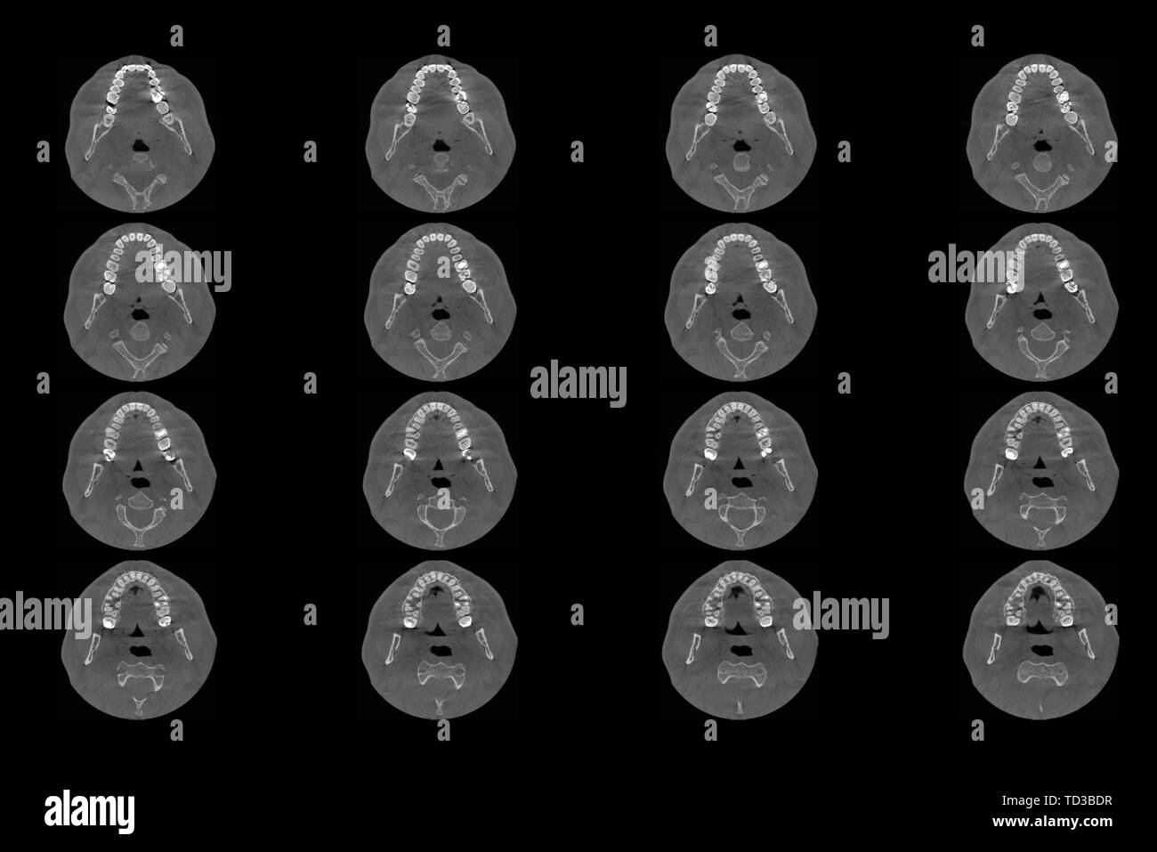 Set of MRI scanner slices of dental part of human male scull with ...