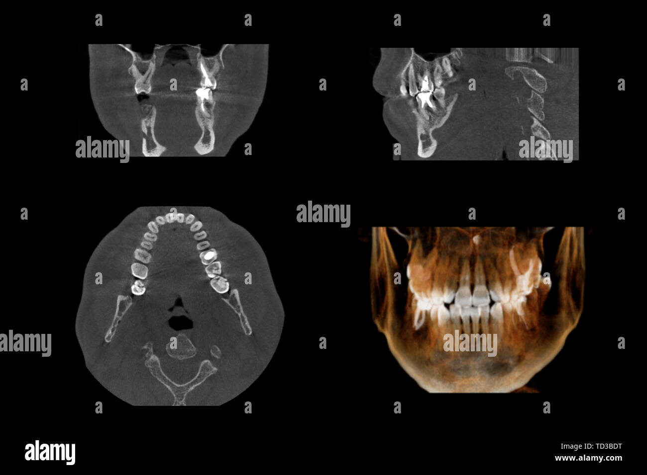 Set of MRI scanner slices of dental part of human male scull with ...
