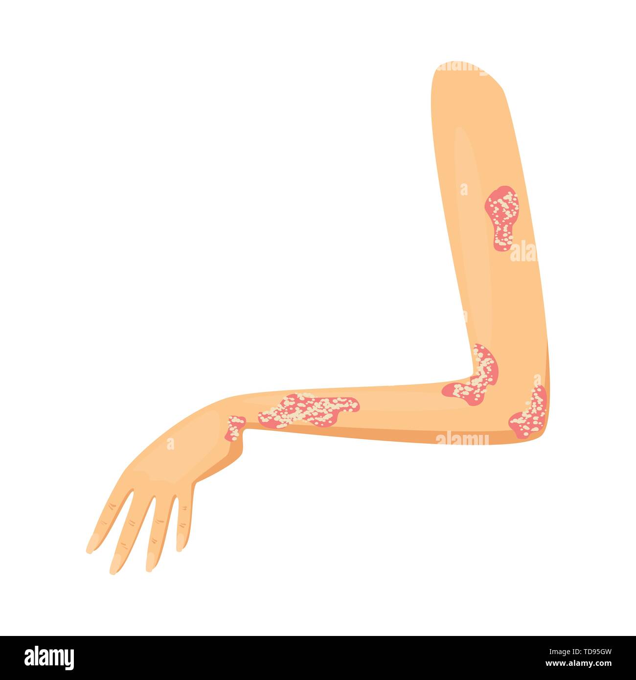Isolated Object Of Psoriasis And Dermatitis Symbol Collection Of