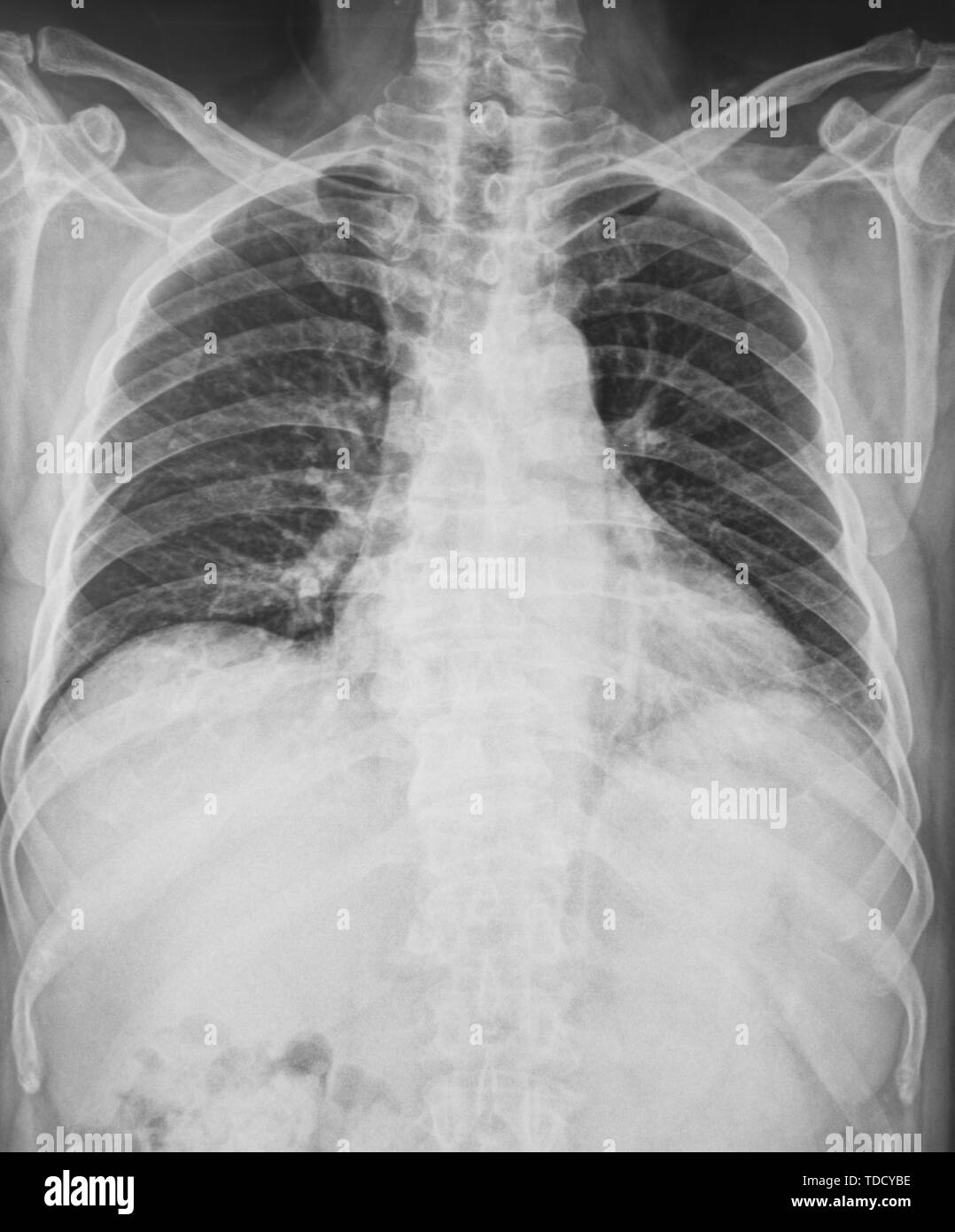 X-Ray Image Of Human Chest Stock Photo - Alamy