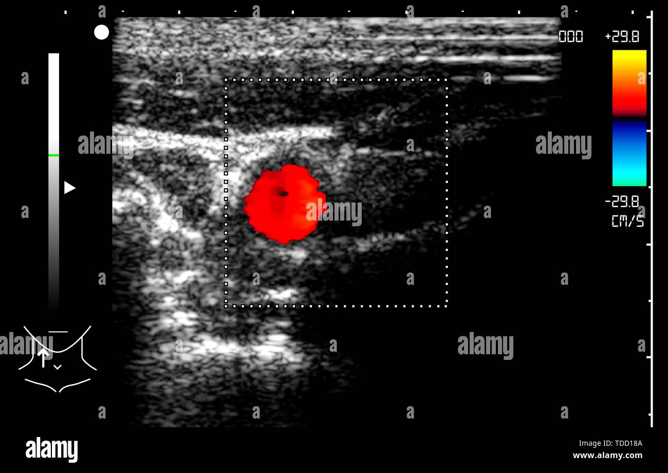 Doppler ultrasound hi-res stock photography and images - Alamy