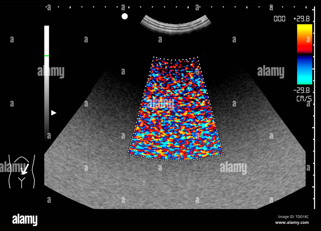Doppler ultrasound hi-res stock photography and images - Alamy