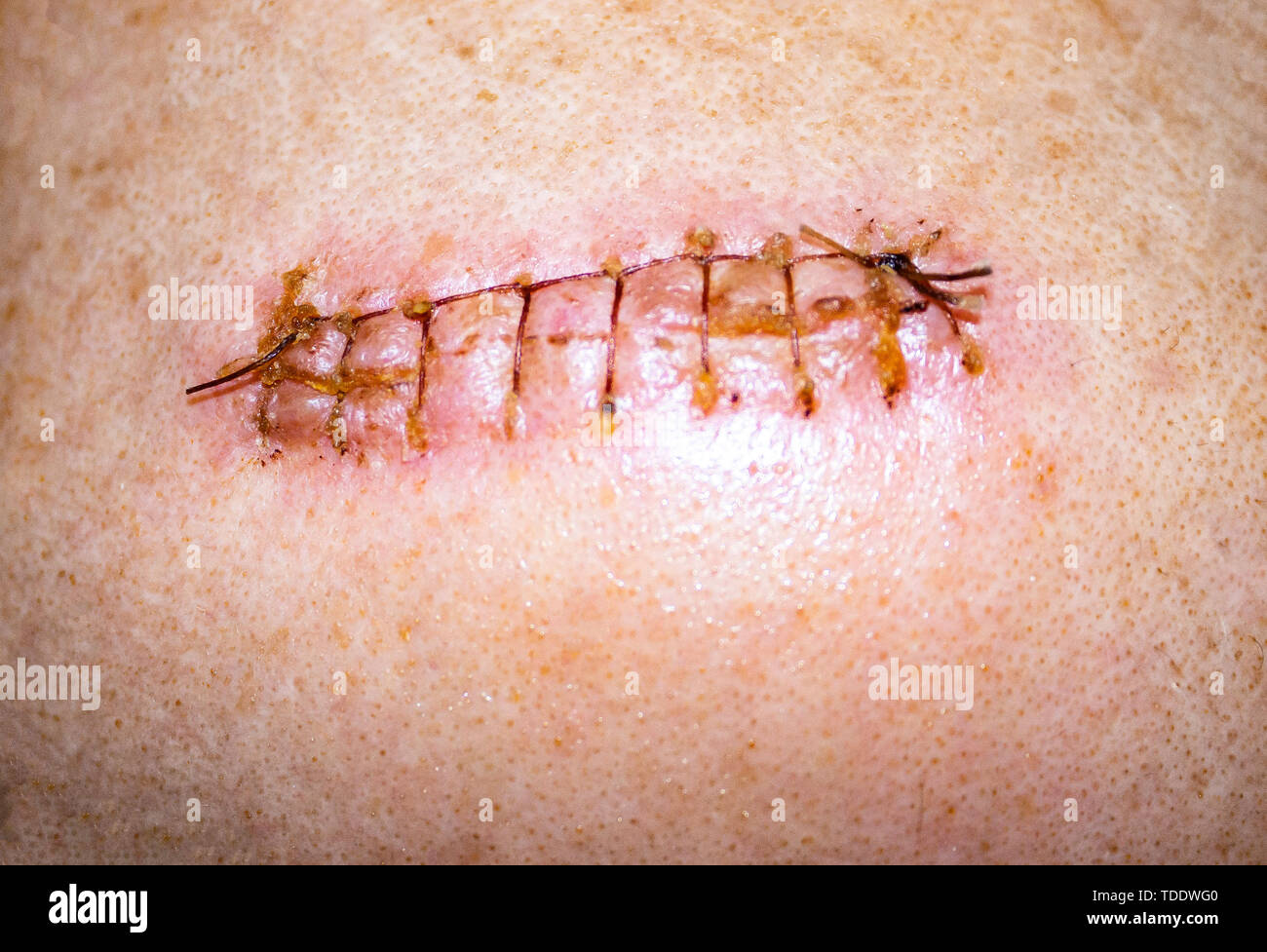 Scar from skin cancer hi-res stock photography and images - Alamy