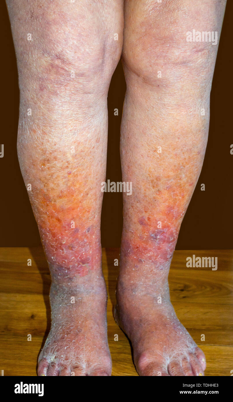 Enlarged veins hi-res stock photography and images - Alamy