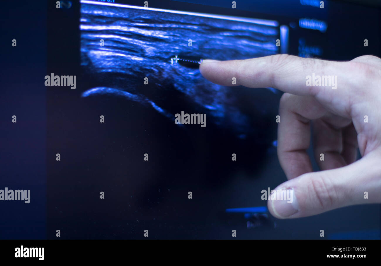 EPI Intratissue Percutaneous Electrolysis dry needling ultrasound ...