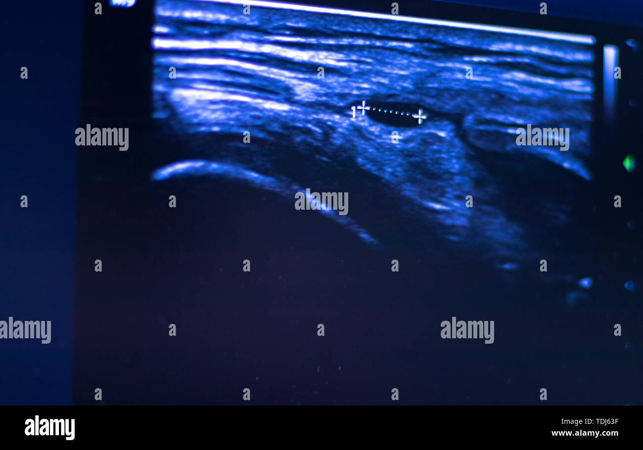 EPI Intratissue Percutaneous Electrolysis dry needling ultrasound ...