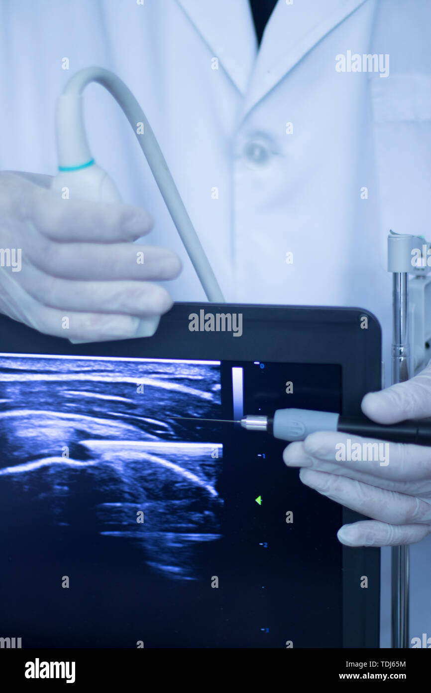 EPI Intratissue Percutaneous Electrolysis dry needling ultrasound ...