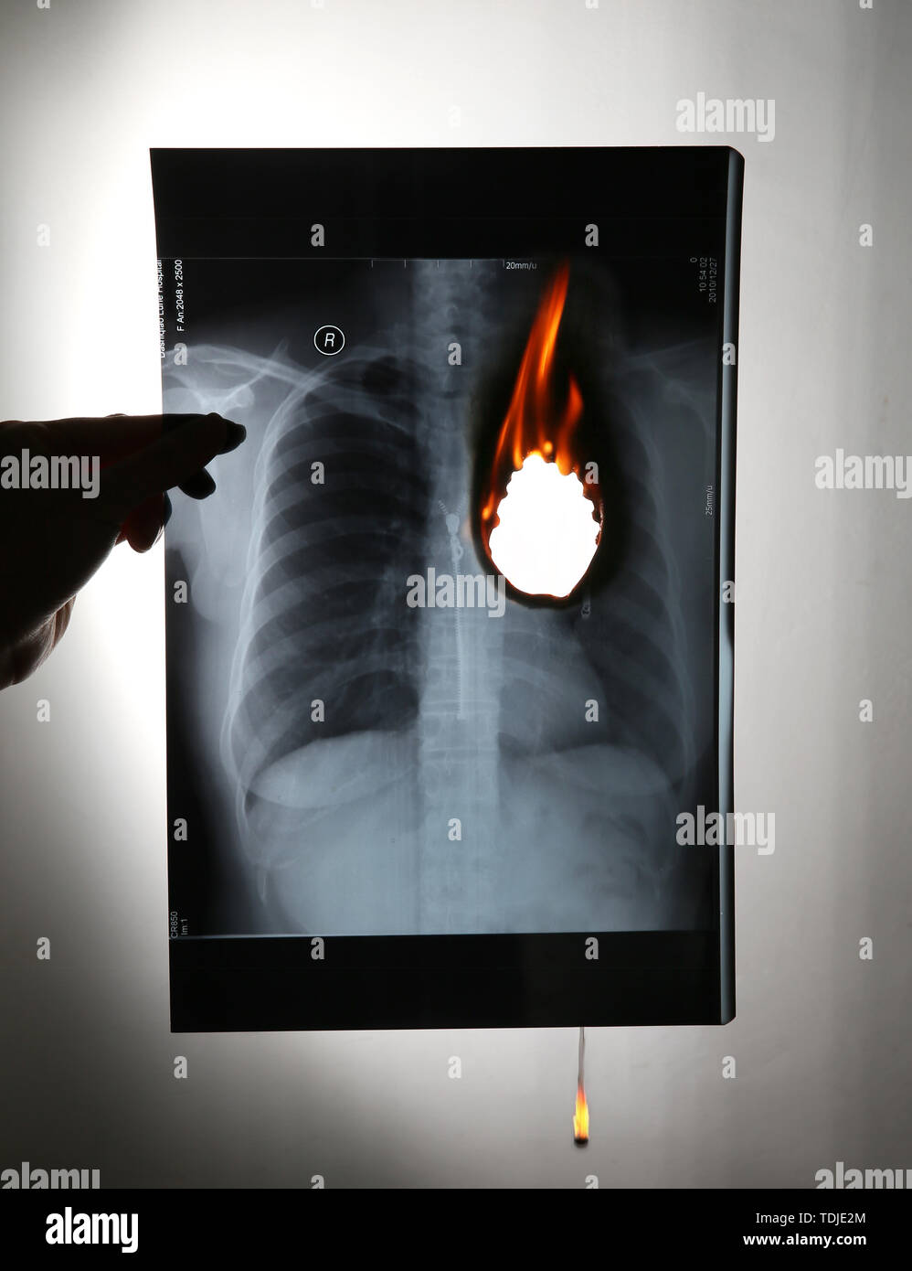X ray burn hi-res stock photography and images - Alamy