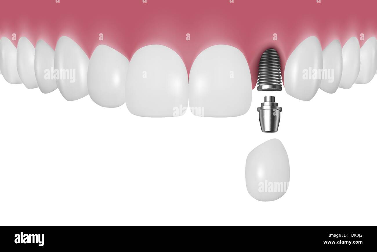 Vector 3d Realistic Render Human Teeth with Implant Closeup Isolated on ...