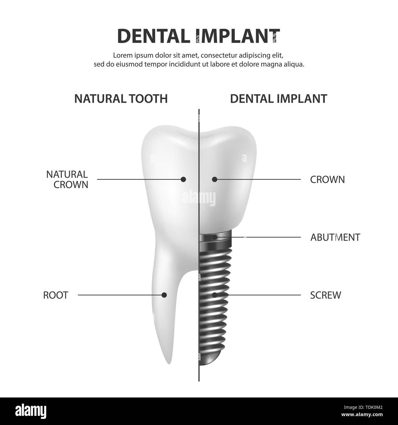 Vector 3d Realistic Render White Tooth Implant Denture Closeup Isolated ...