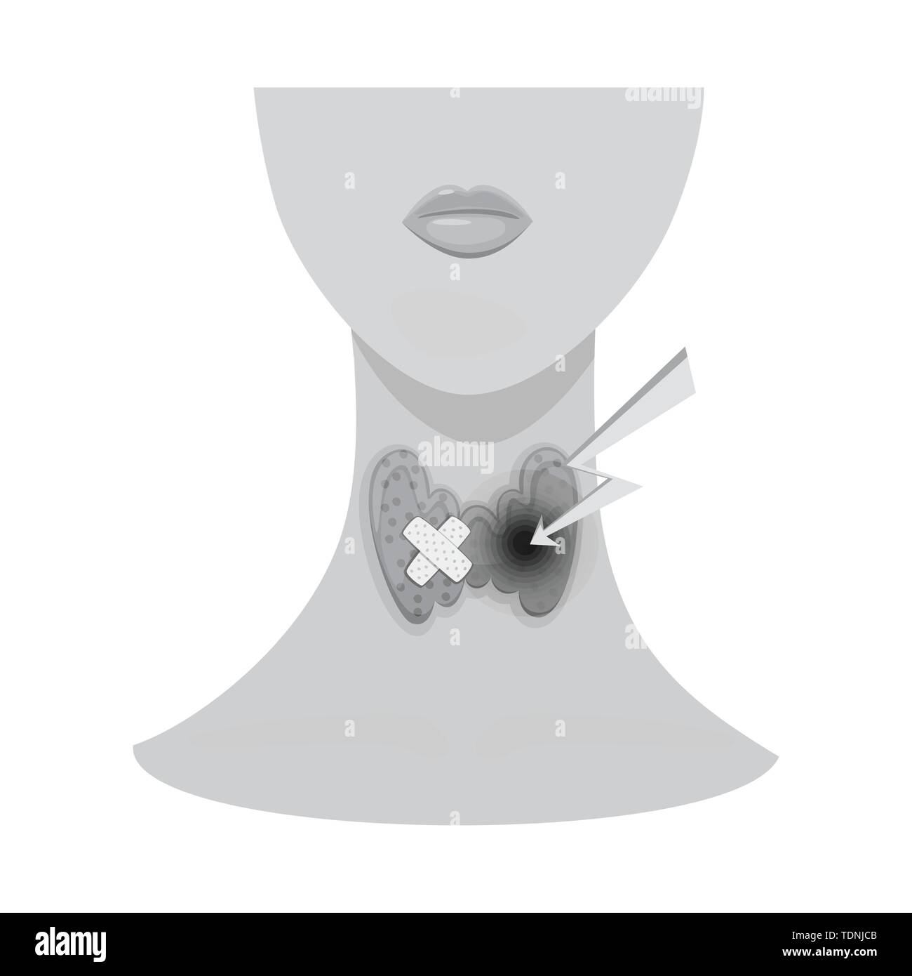 body,human,thyroid,treatment,gland,endocrine,system,neck,anatomy ...