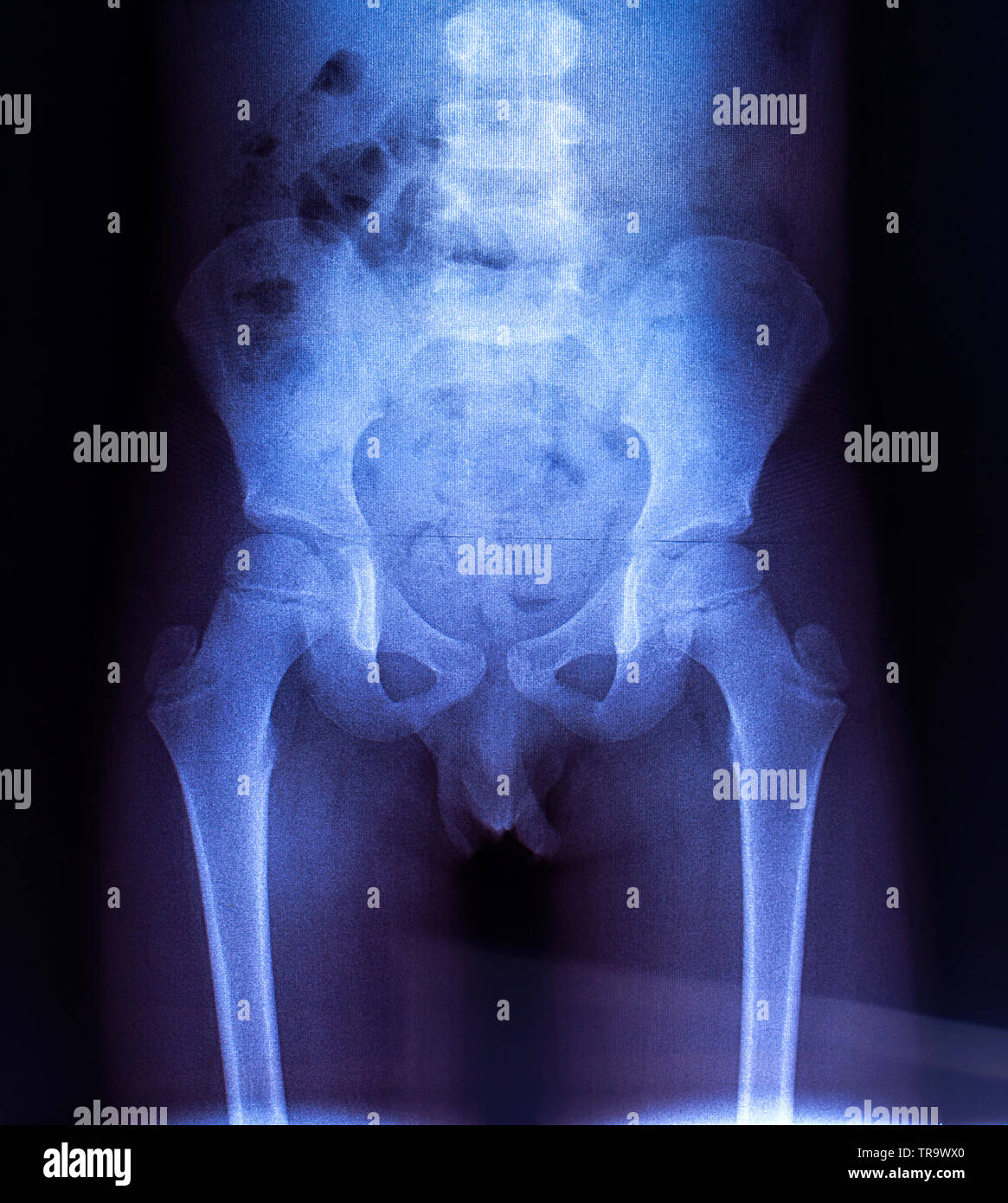 Pelvic bones hi-res stock photography and images - Alamy