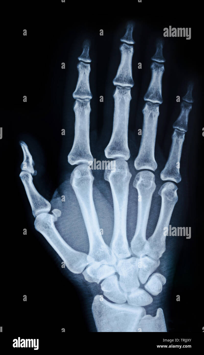 X-ray image of the hand on black background Stock Photo - Alamy