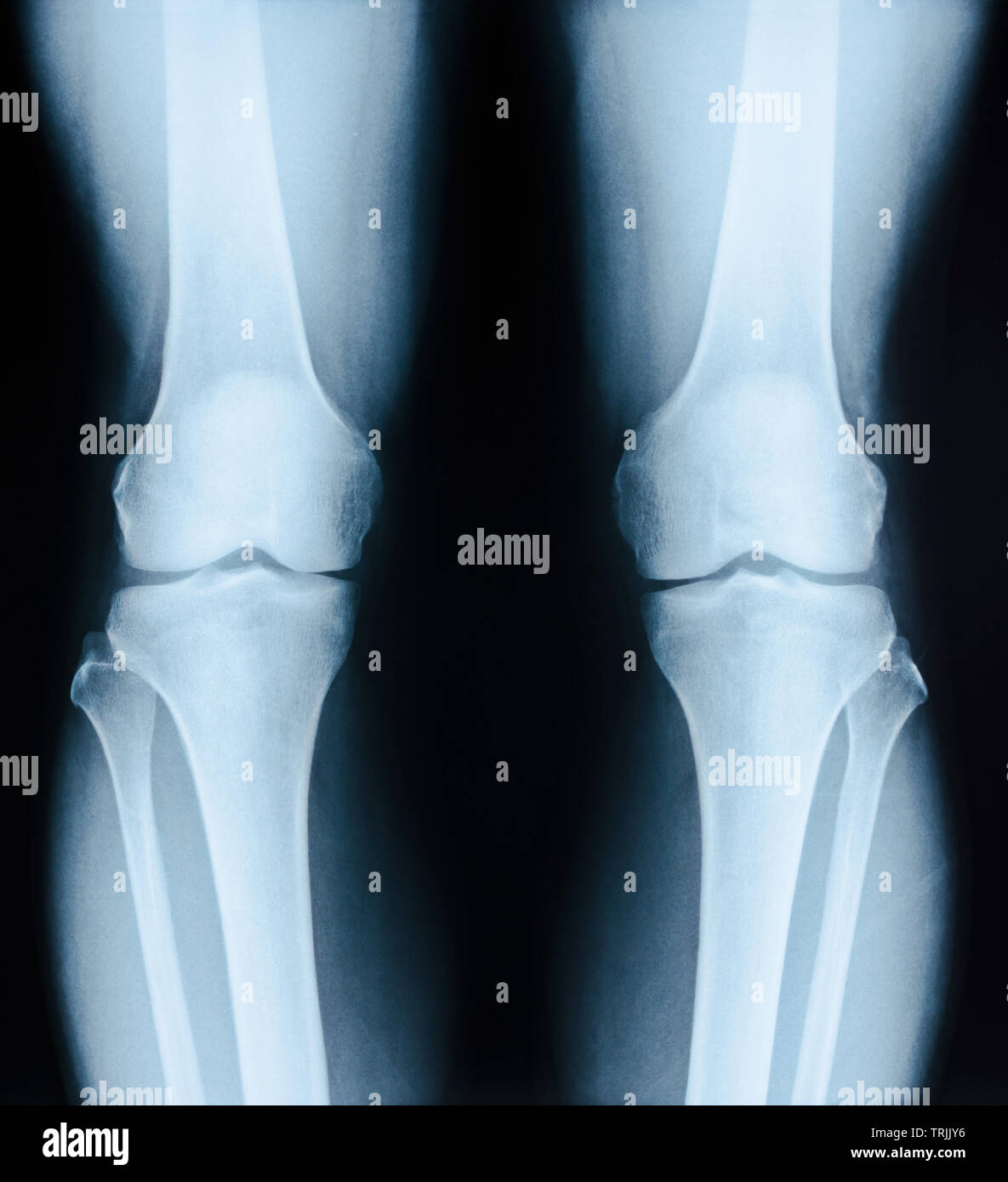 Degenerative osteoarthritis hi-res stock photography and images - Alamy