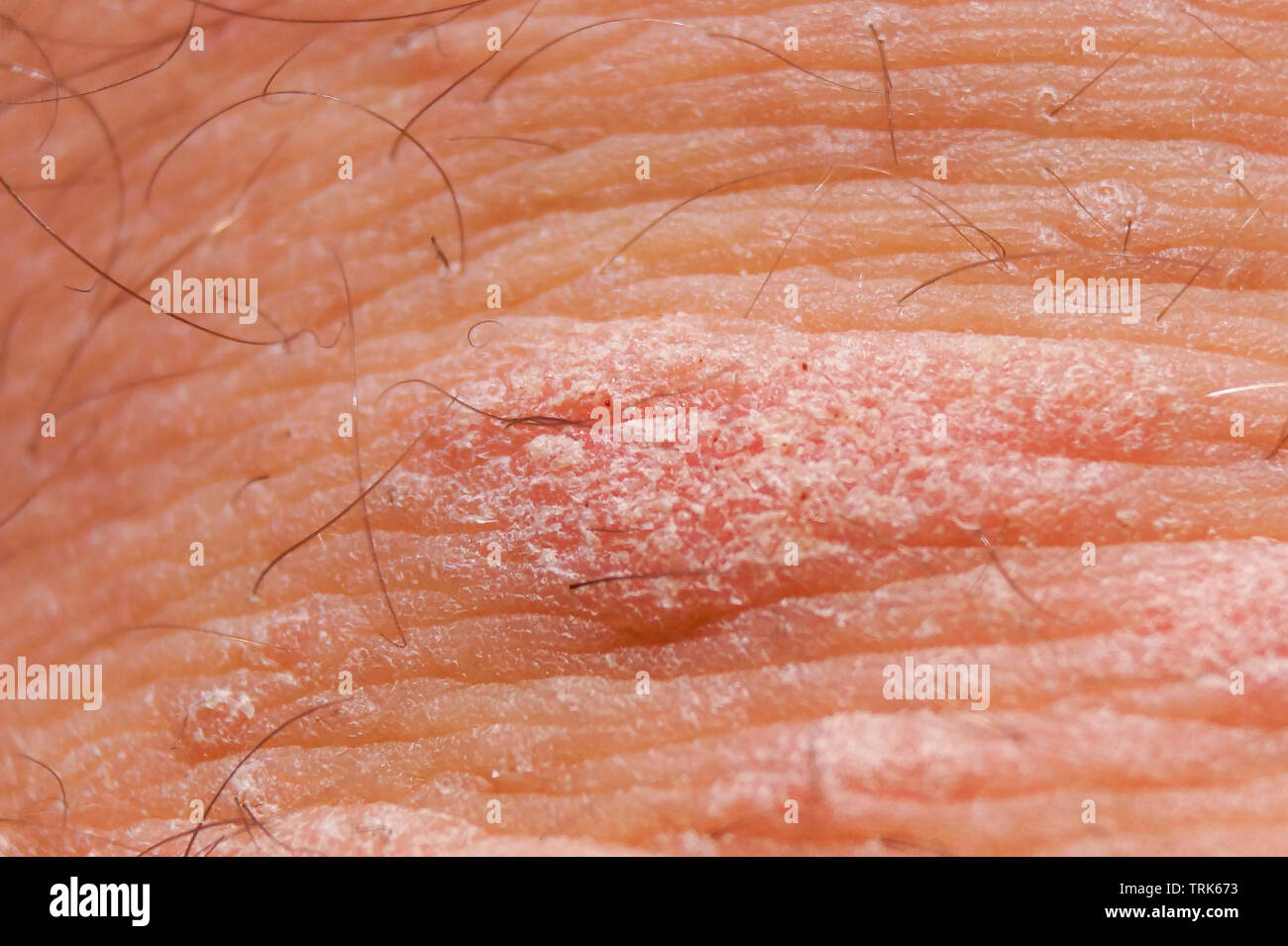 Psoriasis dry red and white irritation on the skin closeup. Image for ...
