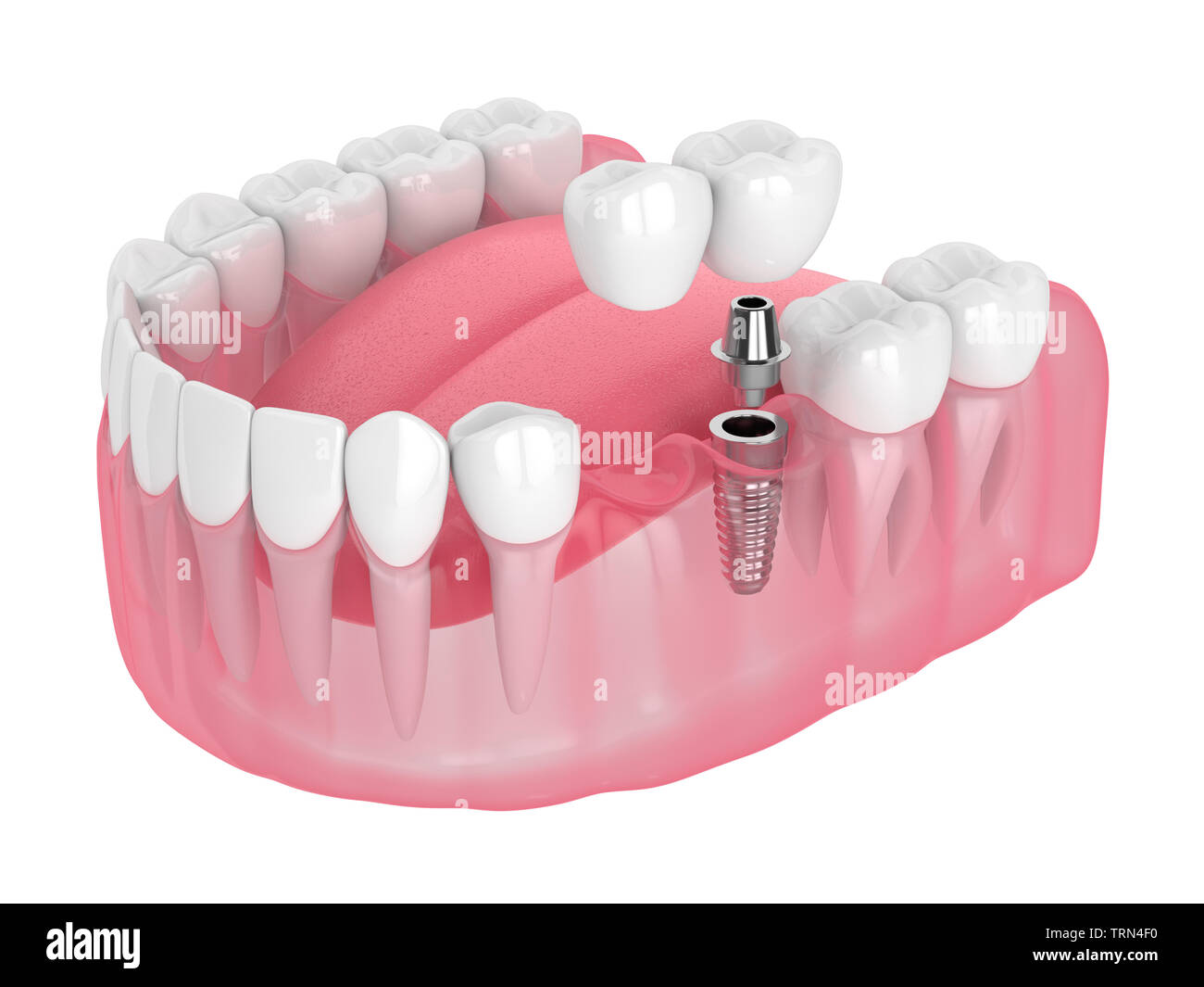 3d render of jaw with implant supported dental cantilever bridge ...