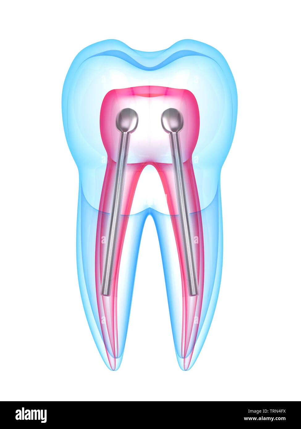 3d render of x-ray tooth with stainless steel dental post over white ...