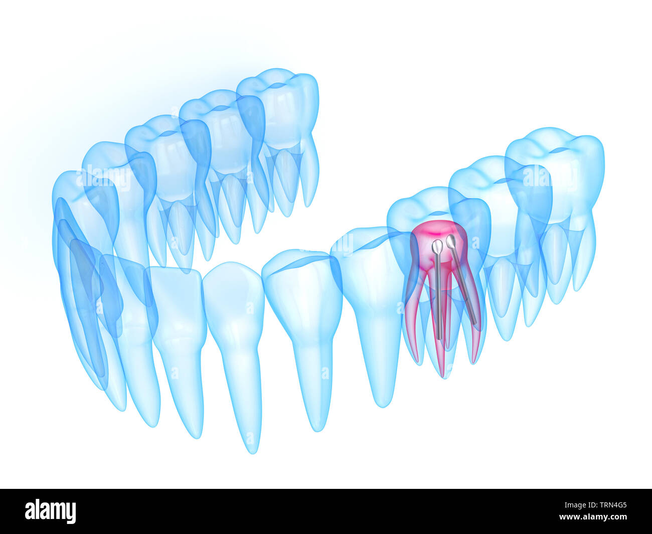 3d render of x-ray toothing with stainless steel dental post over white ...