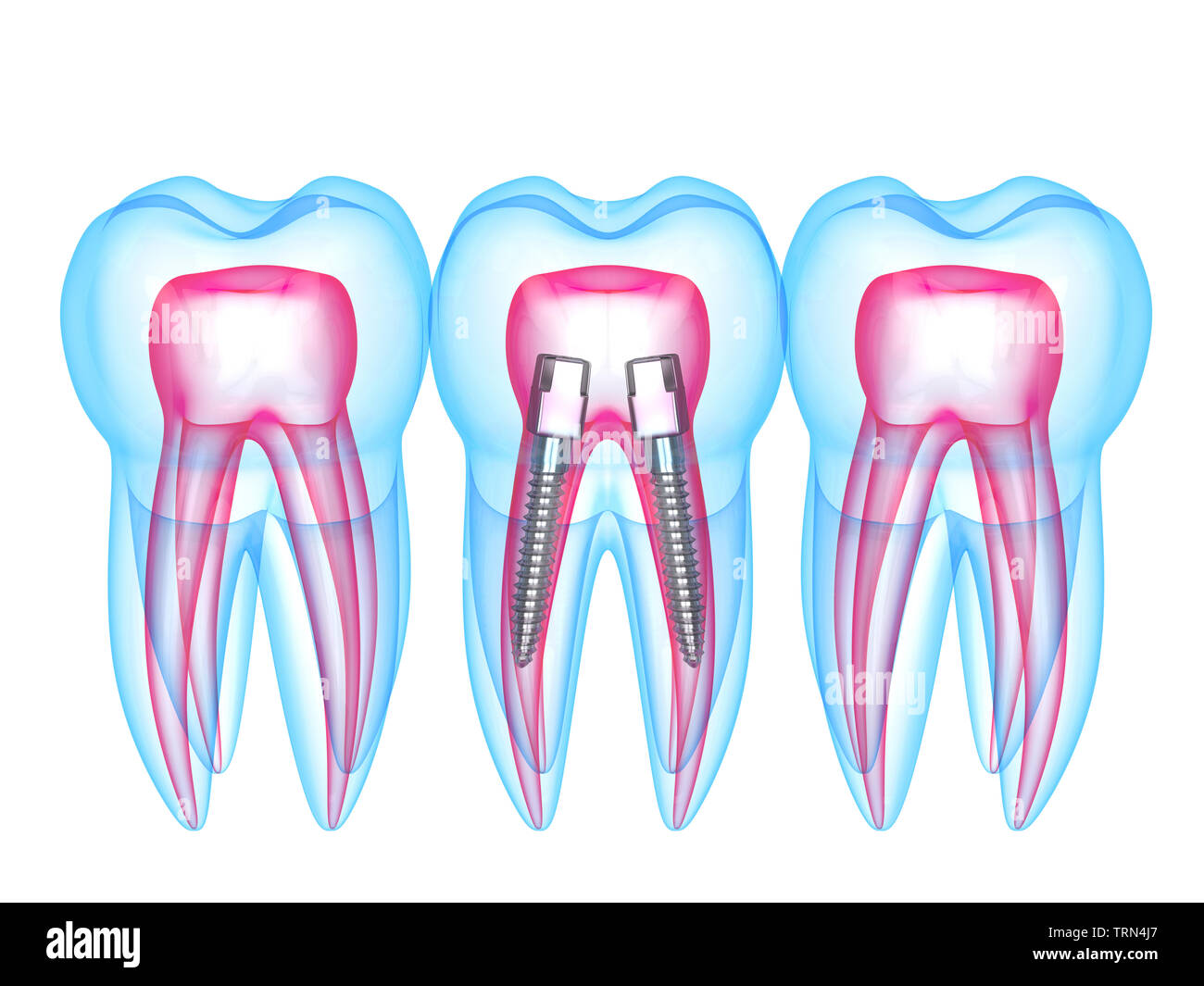 3d render of x-ray teeth with stainless steel dental post over white ...