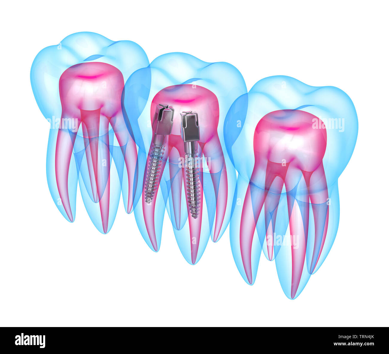 3d render of x-ray teeth with stainless steel dental post over white ...