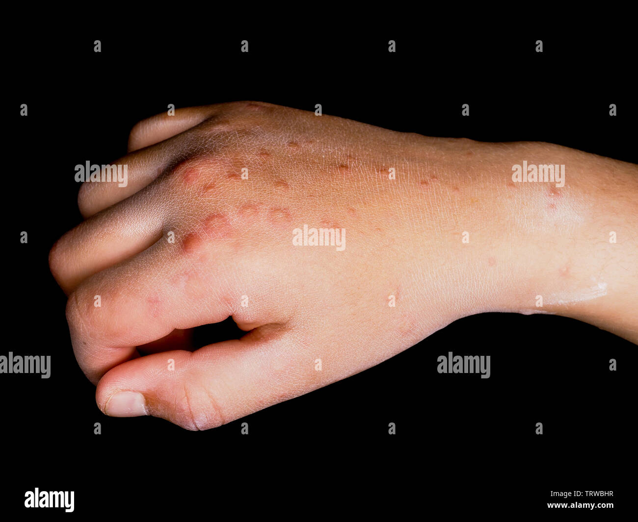 Dry black skin hi-res stock photography and images - Alamy