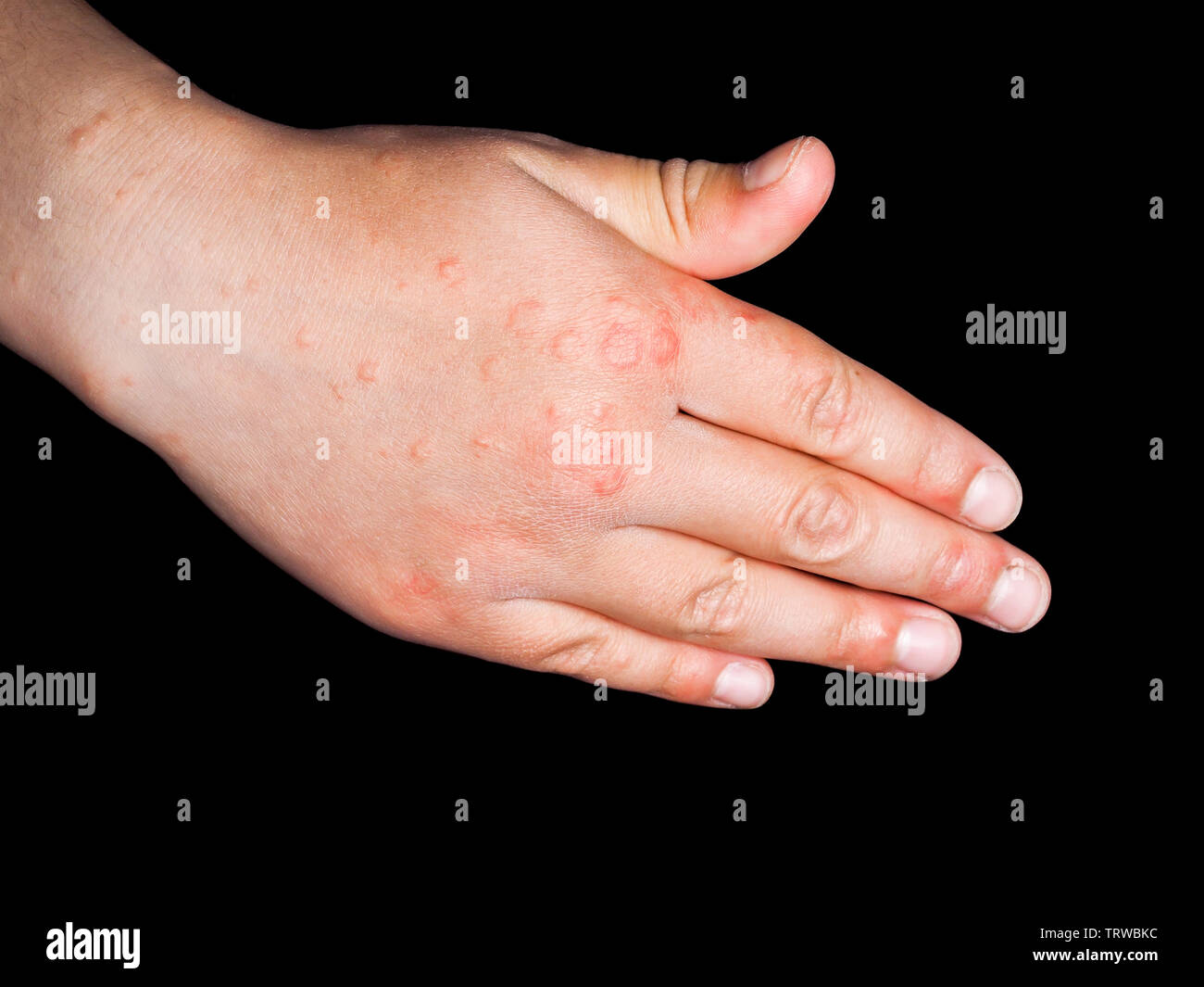 Skin red spots hi-res stock photography and images - Alamy