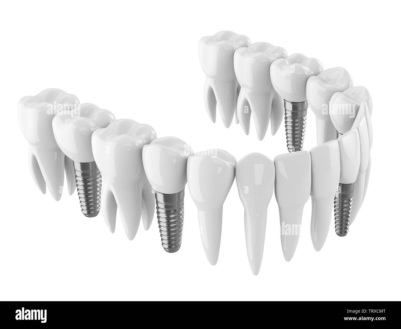 3d render of toothing with dental implants isolated over white ...