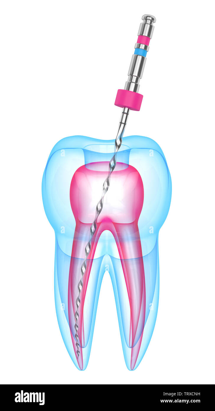 3d render of tooth with endodontic file over white background. Root ...