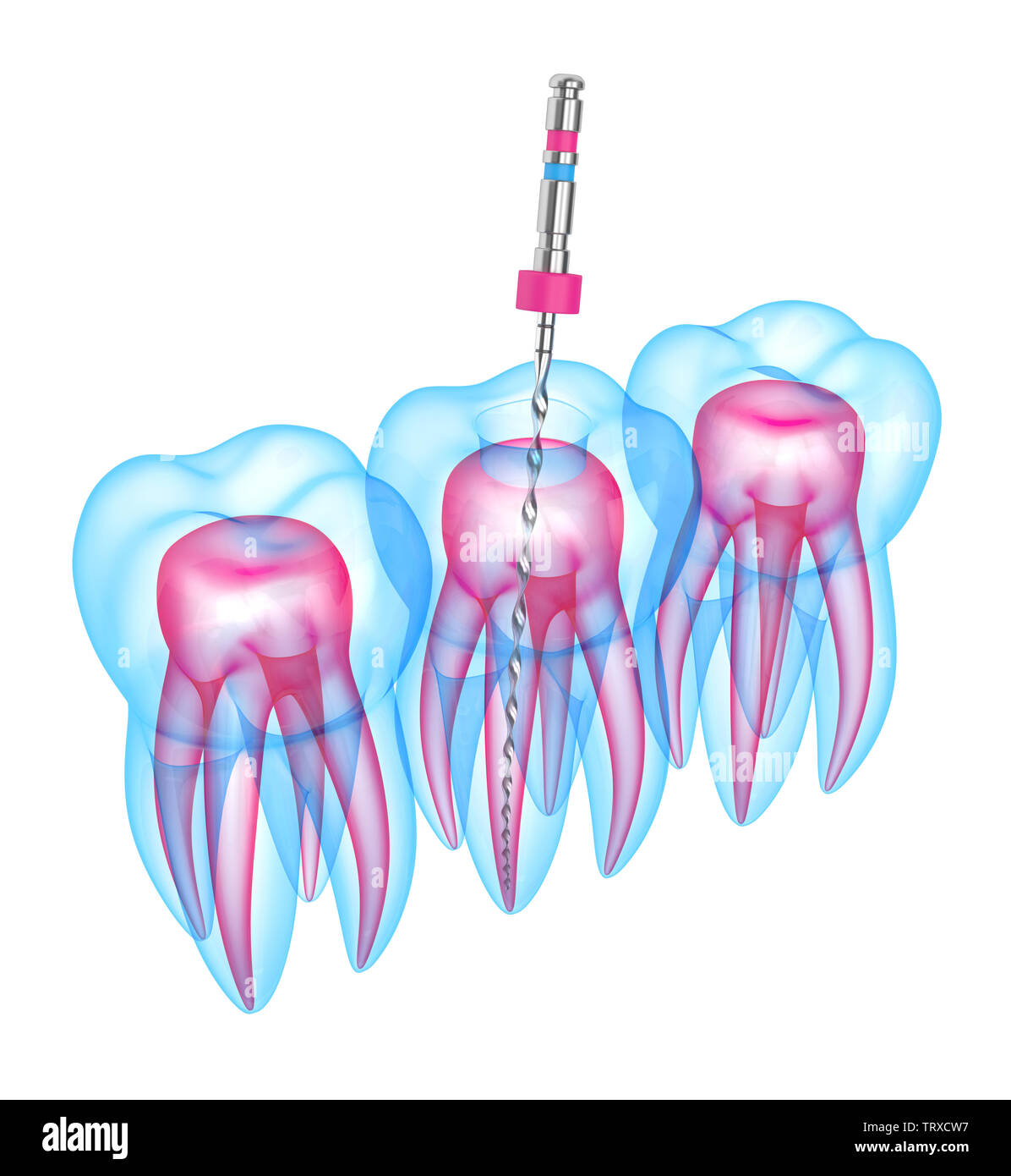 3d render of teeth with endodontic file over white background. Root ...