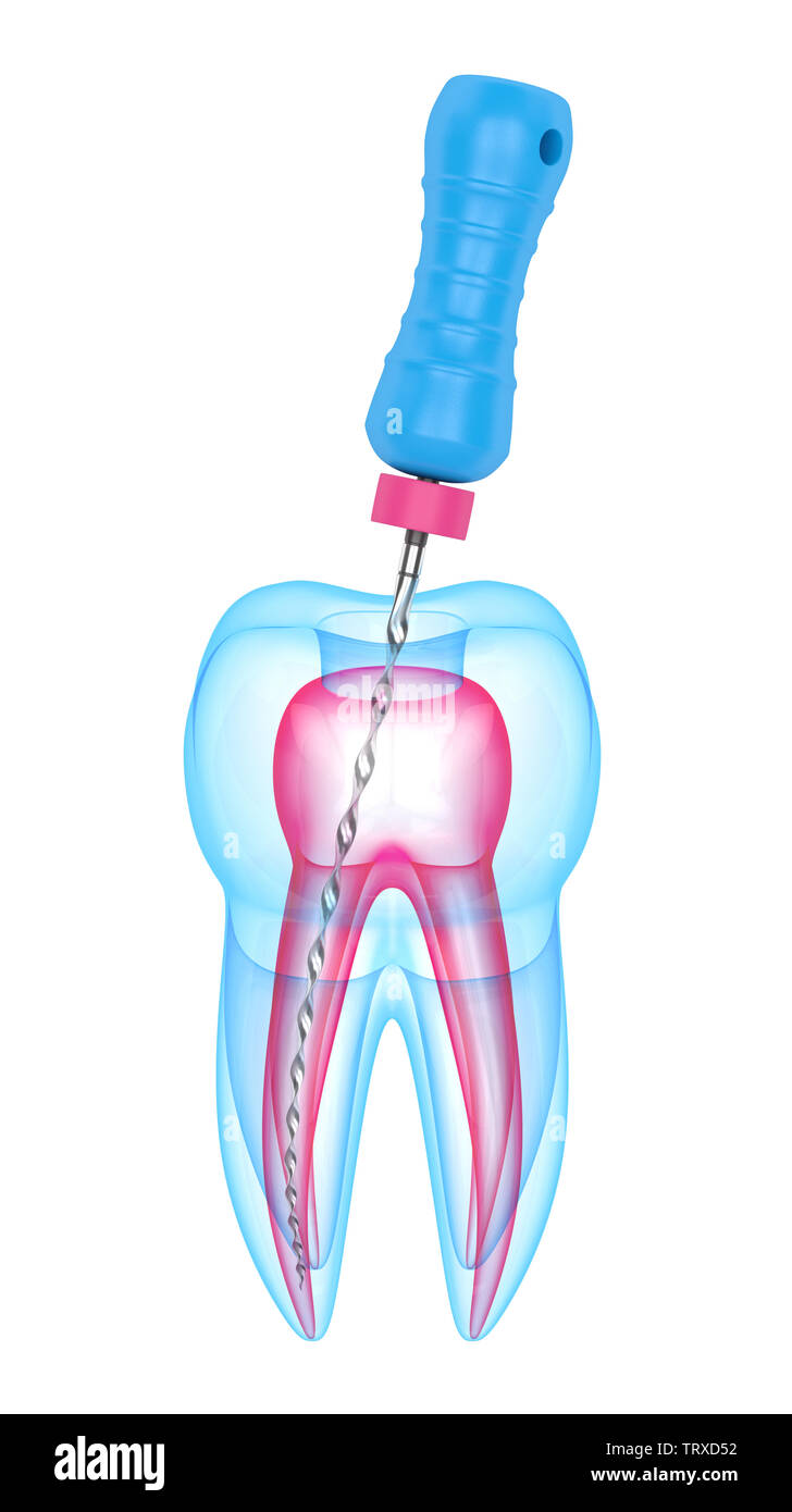 3d render of tooth with endodontic file over white background. Root ...