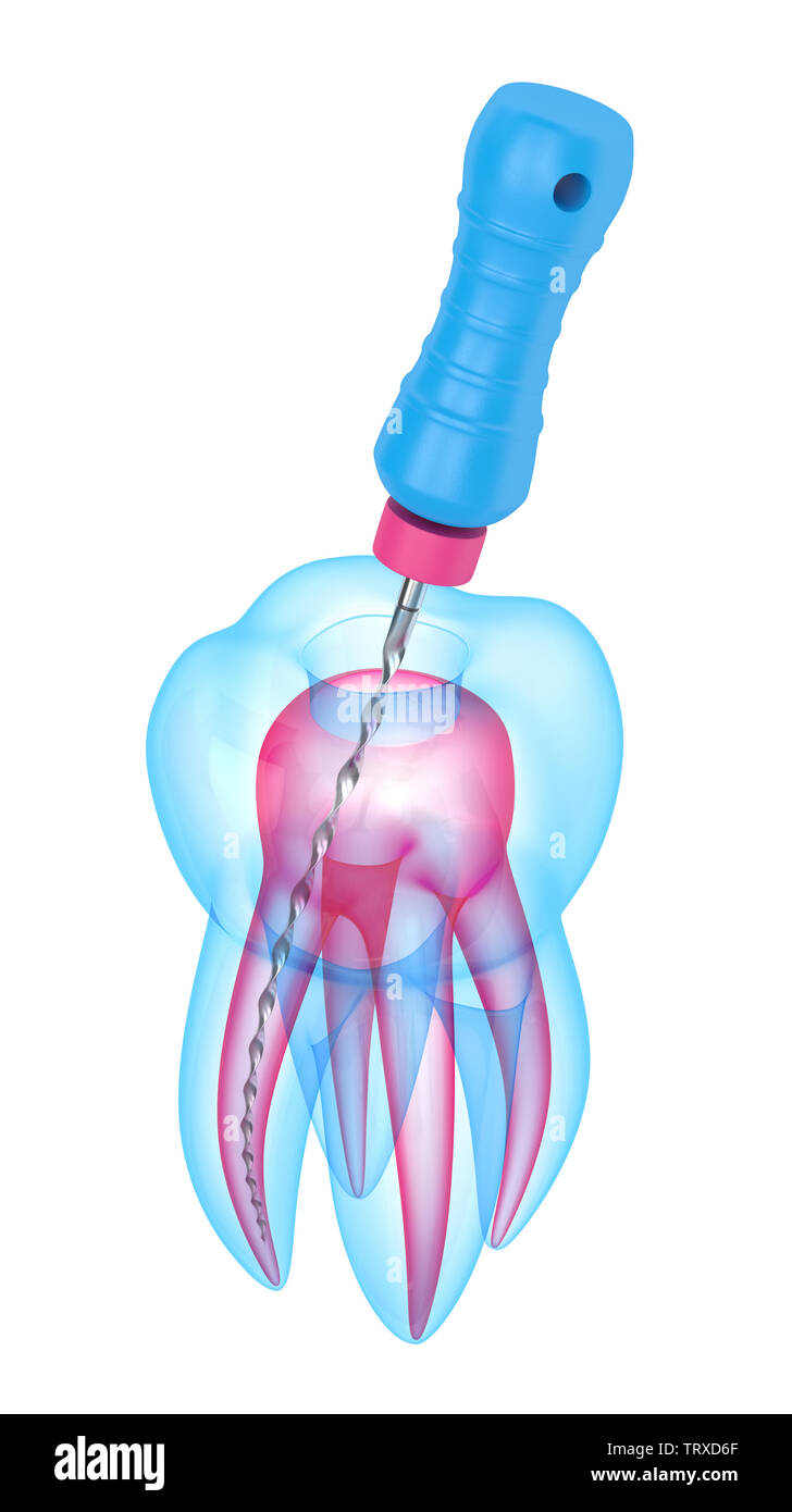3d render of tooth with endodontic file over white background. Root ...