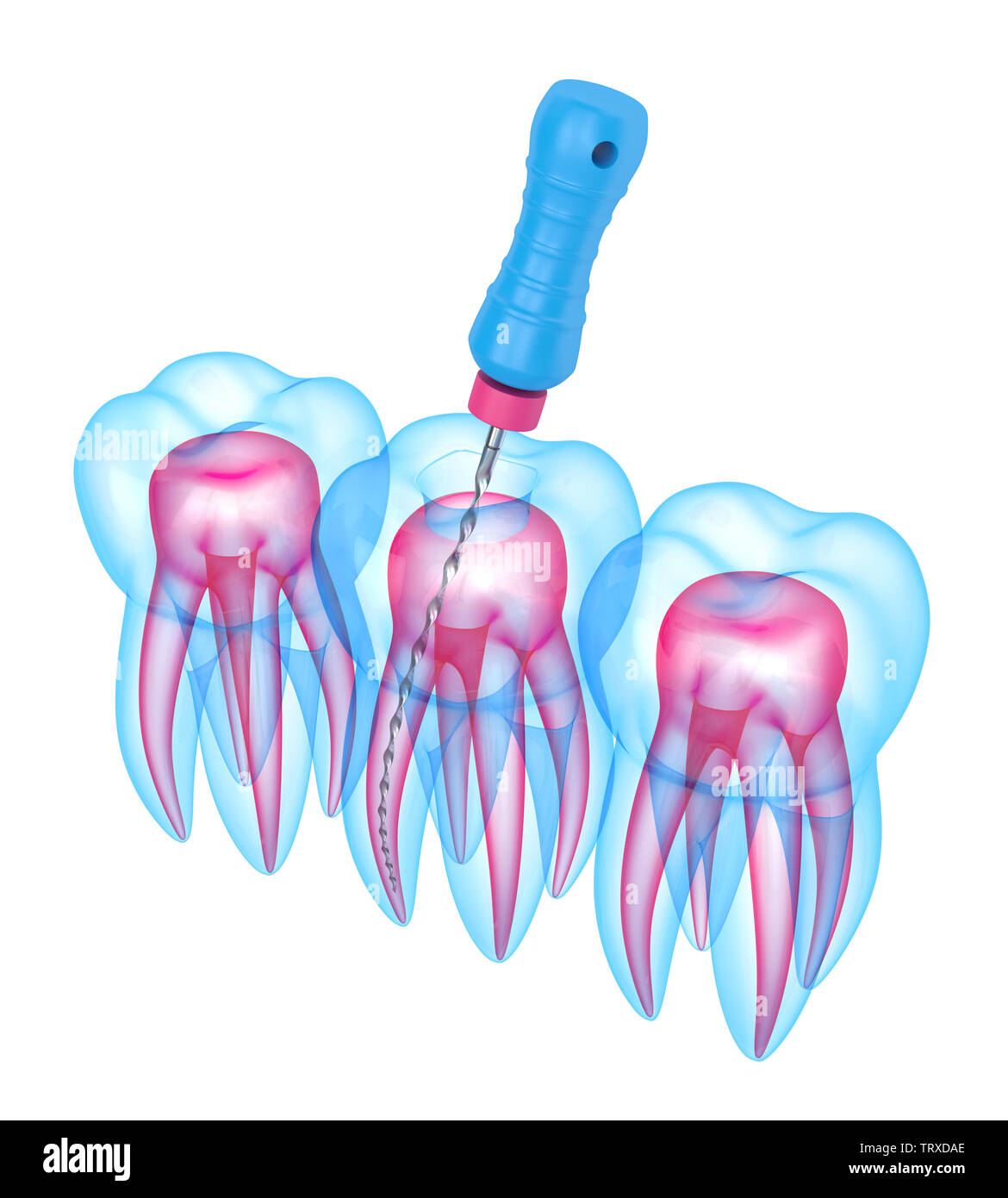 3d render of tooth with endodontic file over white background. Root ...