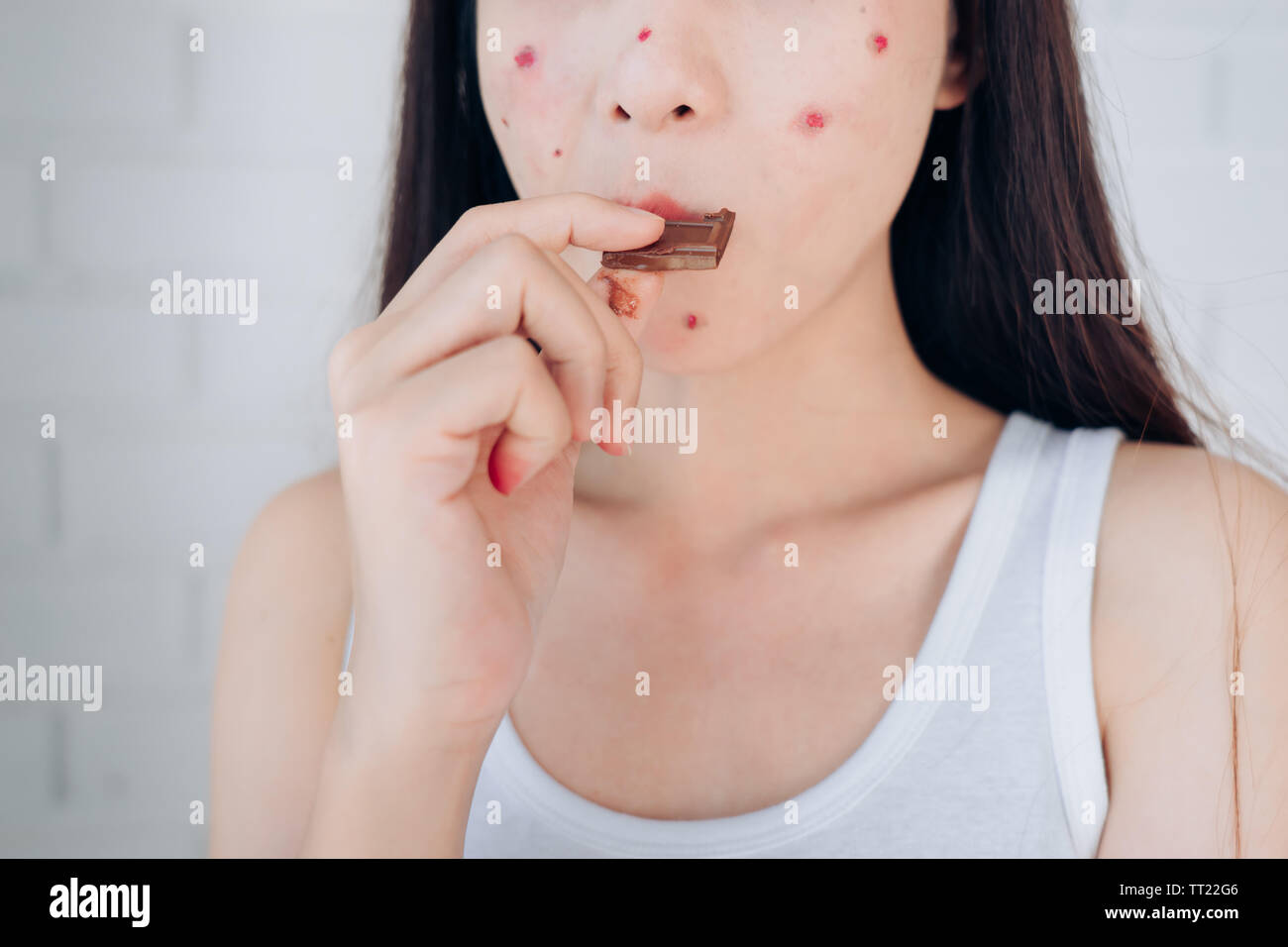 Acne Problem High Resolution Stock Photography and Images - Alamy