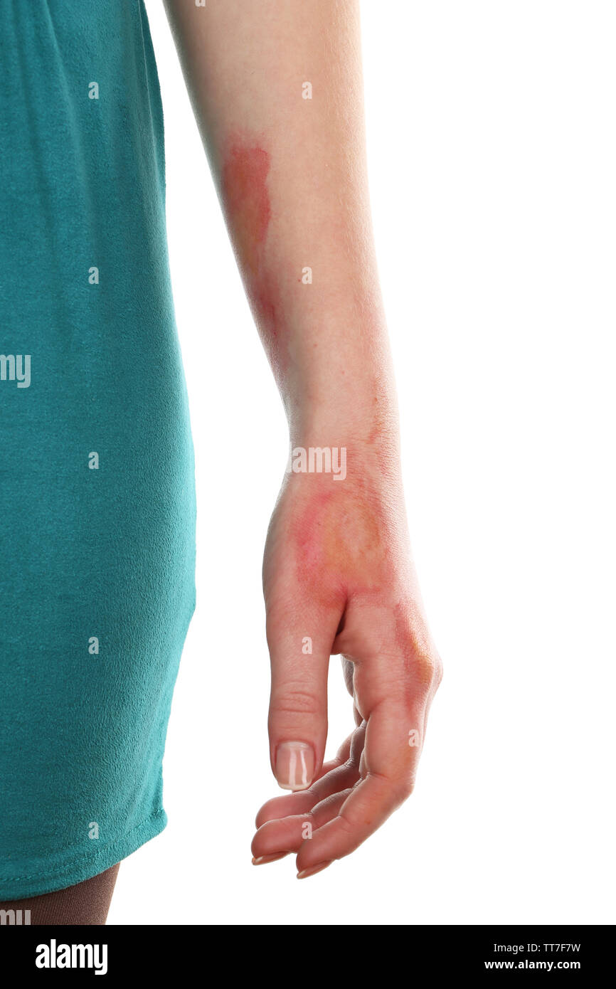 Horrible burns on female hand isolated on white Stock Photo - Alamy