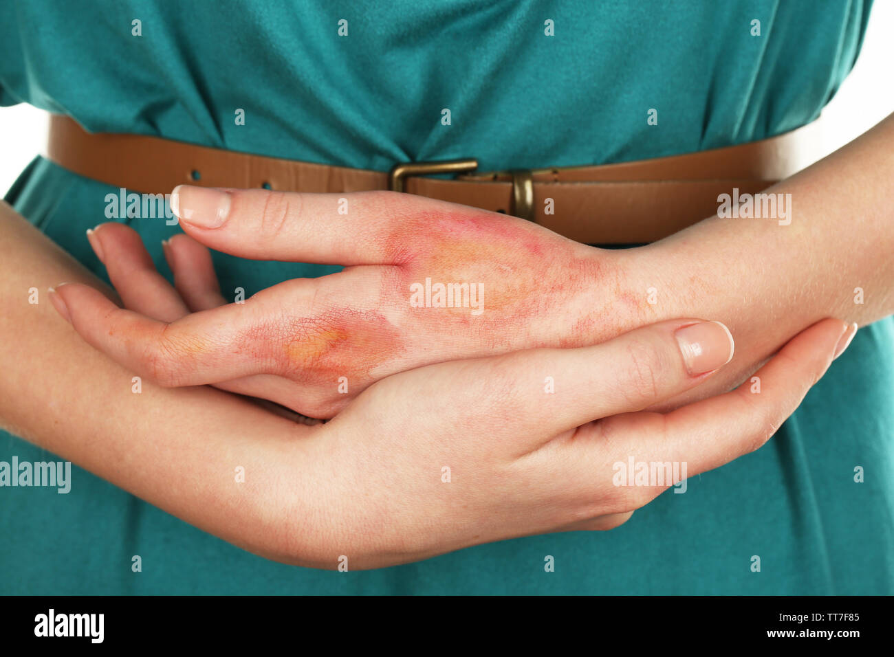 Horrible burns on female hand on white background Stock Photo - Alamy