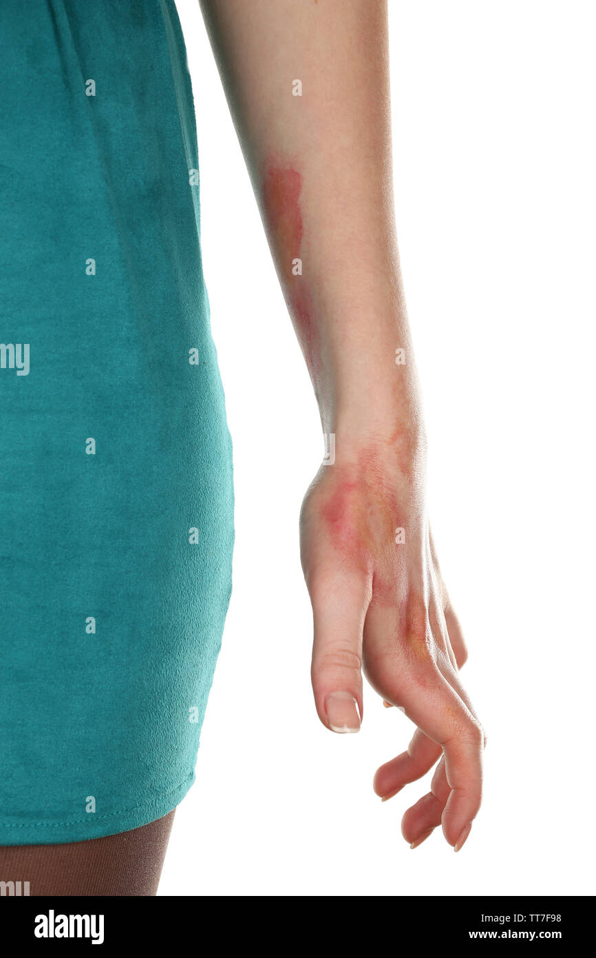 Burn Scar Hand Stock Photos & Burn Scar Hand Stock Images - Alamy