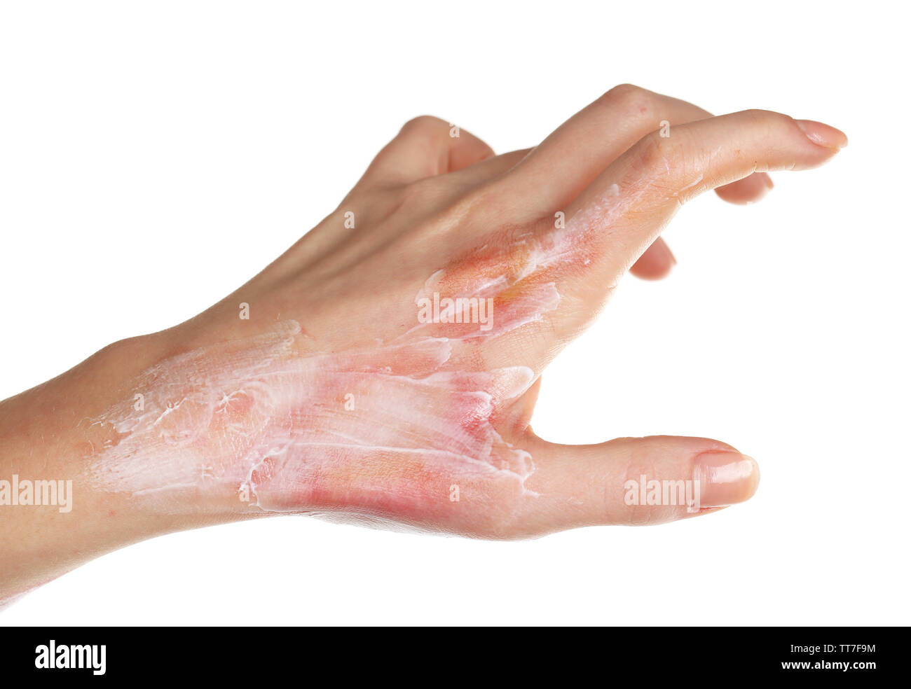 Burn injury treatment Cut Out Stock Images & Pictures - Alamy