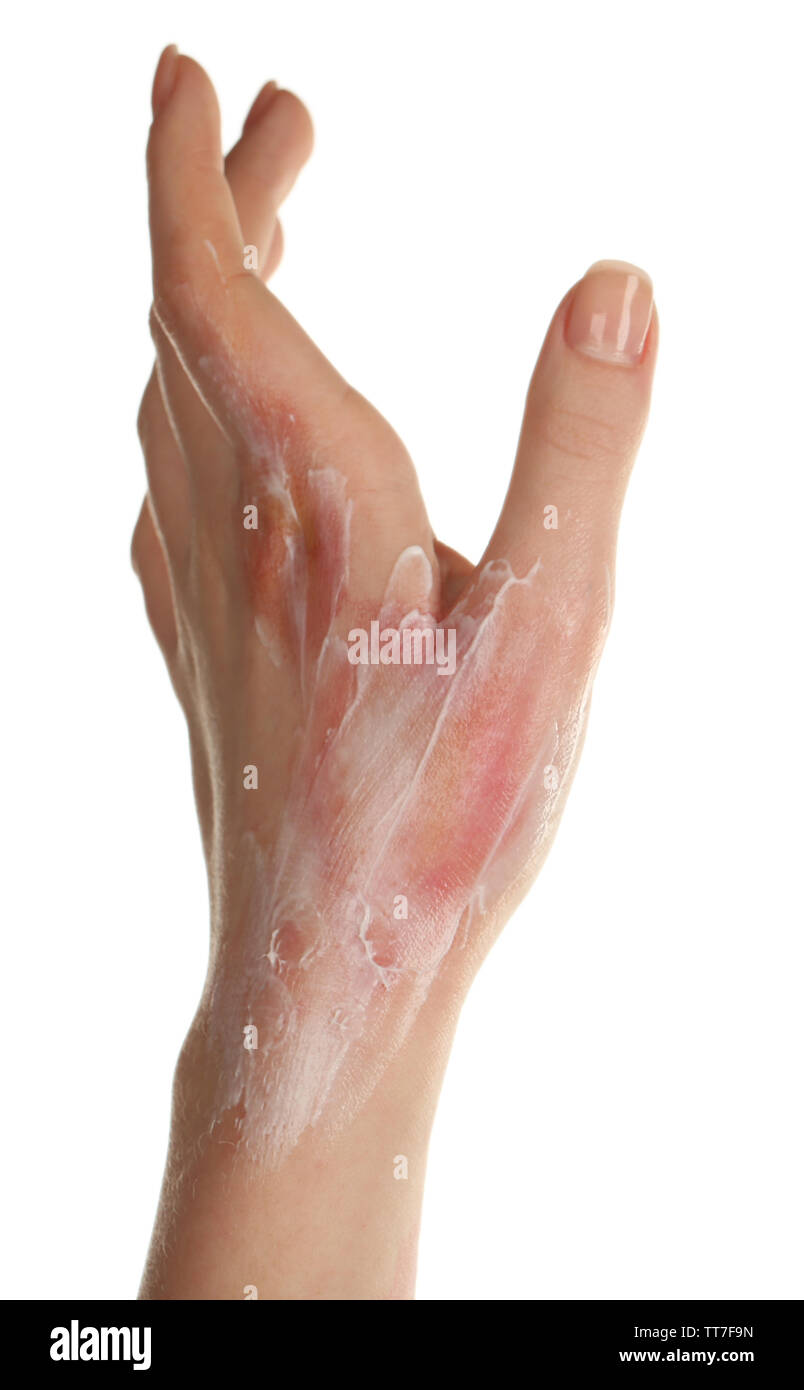Treatment of burns on female hand isolated on white Stock Photo - Alamy