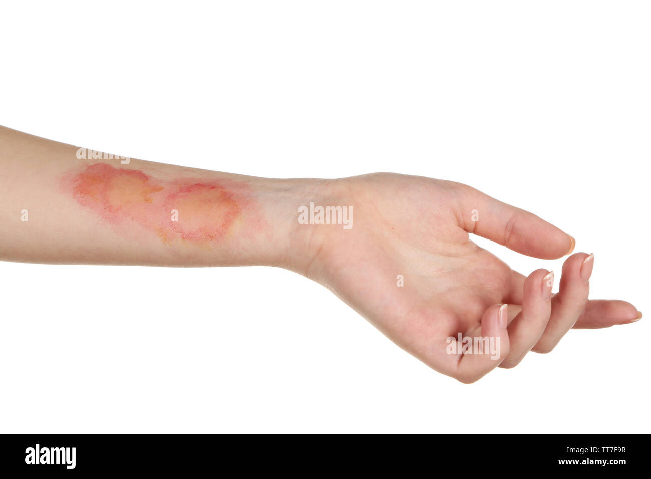 Horrible burns on female hand isolated on white Stock Photo - Alamy