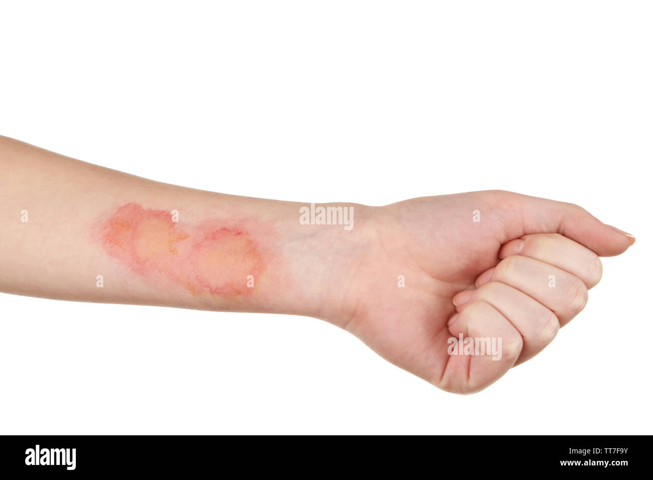 Burn Scar Hand Stock Photos & Burn Scar Hand Stock Images - Alamy