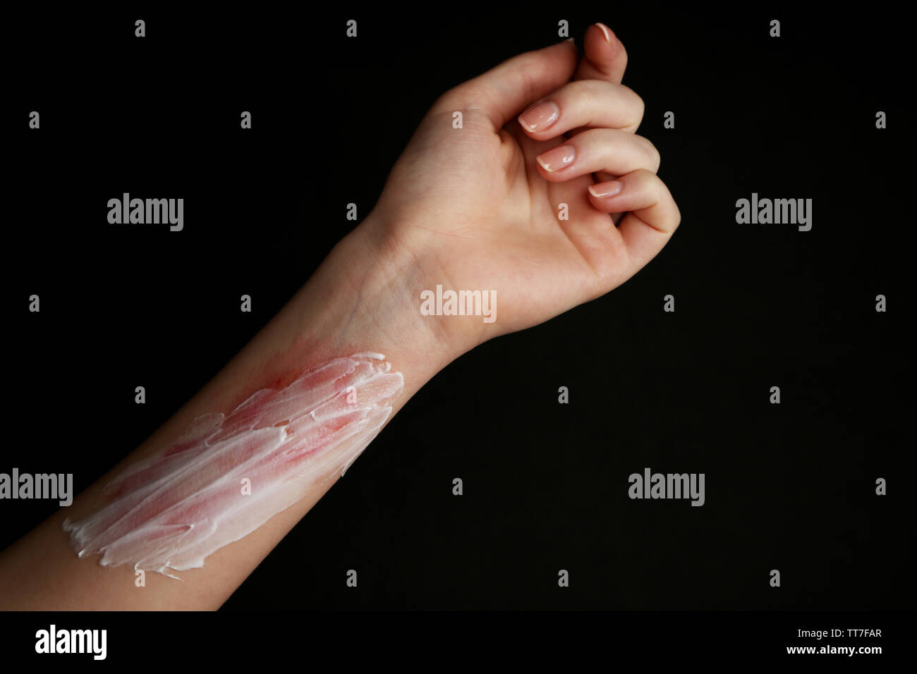 Treatment of burns on female hand on black background Stock Photo - Alamy