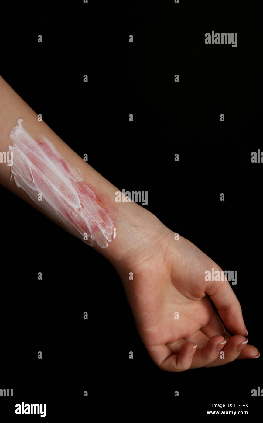 Treatment of burns on female hand on black background Stock Photo - Alamy