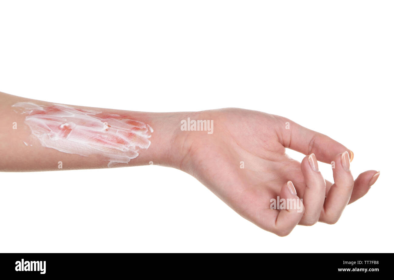 Treatment of burns on female hand isolated on white Stock Photo - Alamy