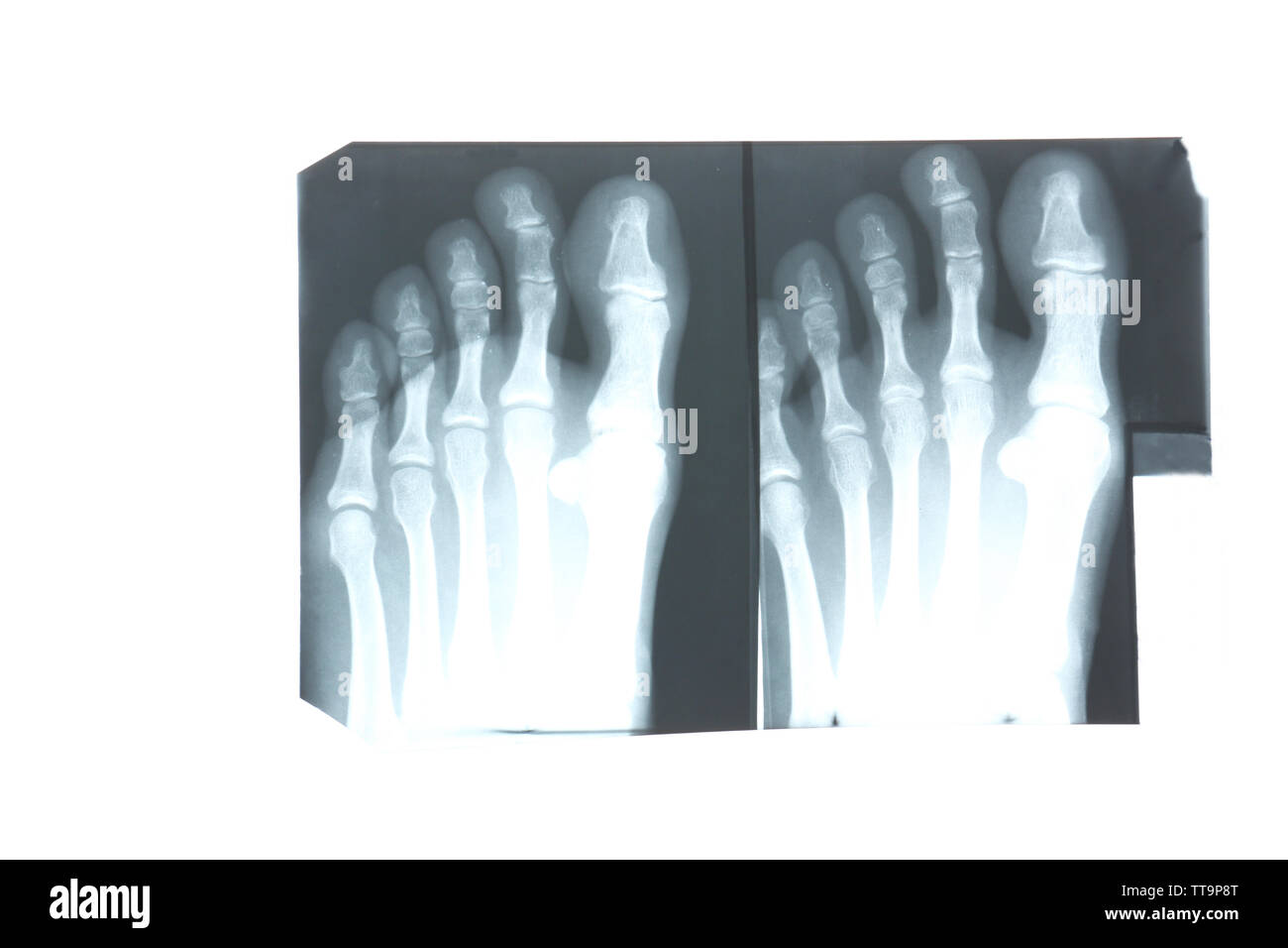 X-ray of feet isolated on white Stock Photo - Alamy