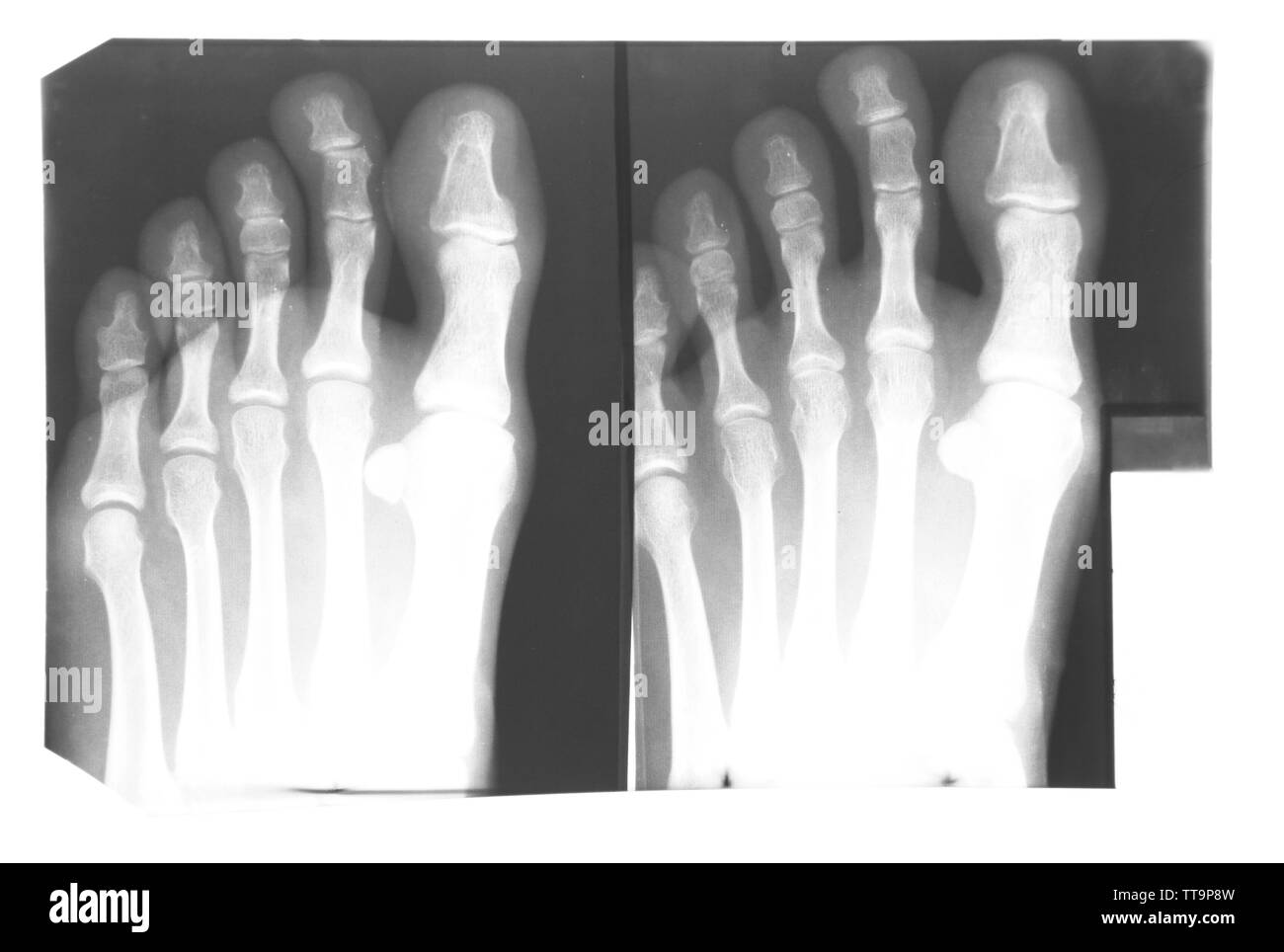 Bone scan of legs and feet Black and White Stock Photos & Images - Alamy