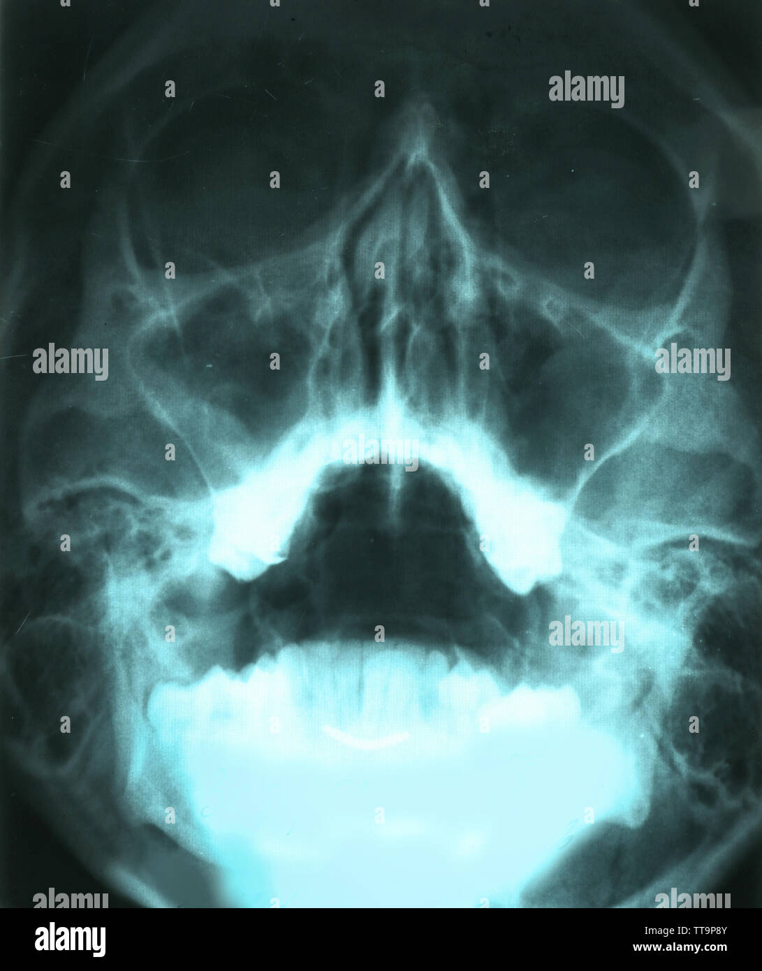 Backbone on ray human hi-res stock photography and images - Alamy