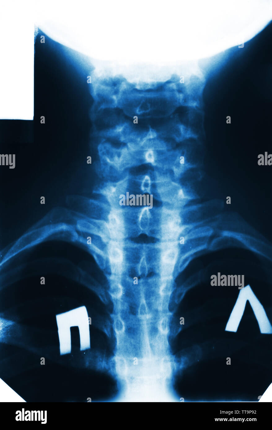 Human joint x ray gray background hi-res stock photography and images ...