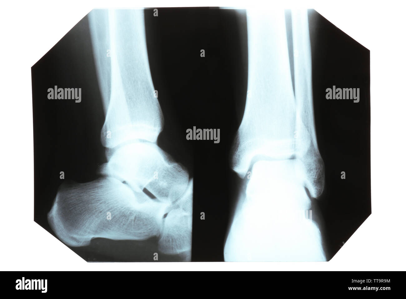 Human joint x ray gray background hi-res stock photography and images ...